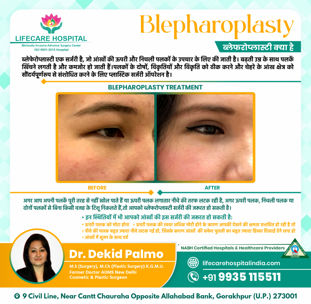 Blepharoplasty - LIFECARE HOSPITAL