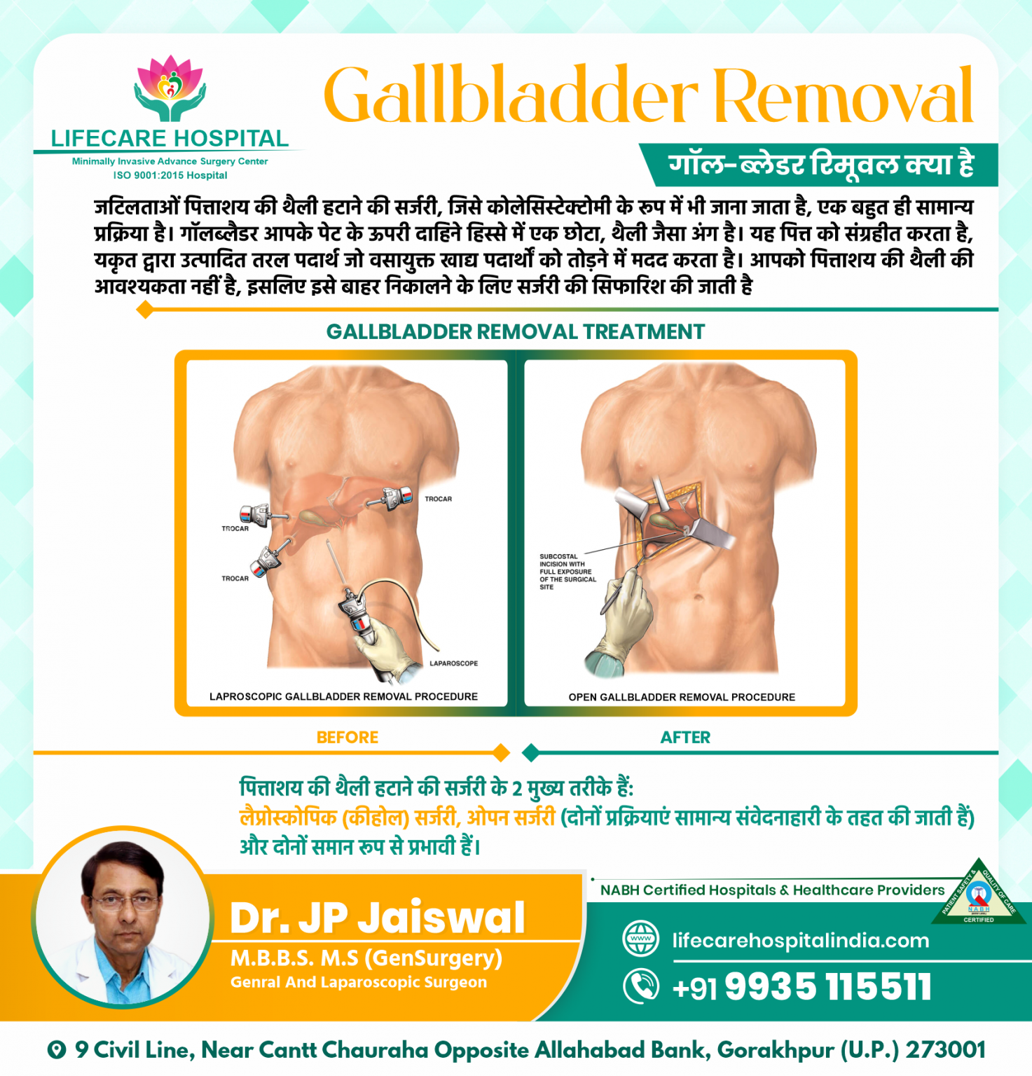 Gallbladder Removal LIFECARE HOSPITAL Gallbladder Removal LIFECARE HOSPITAL