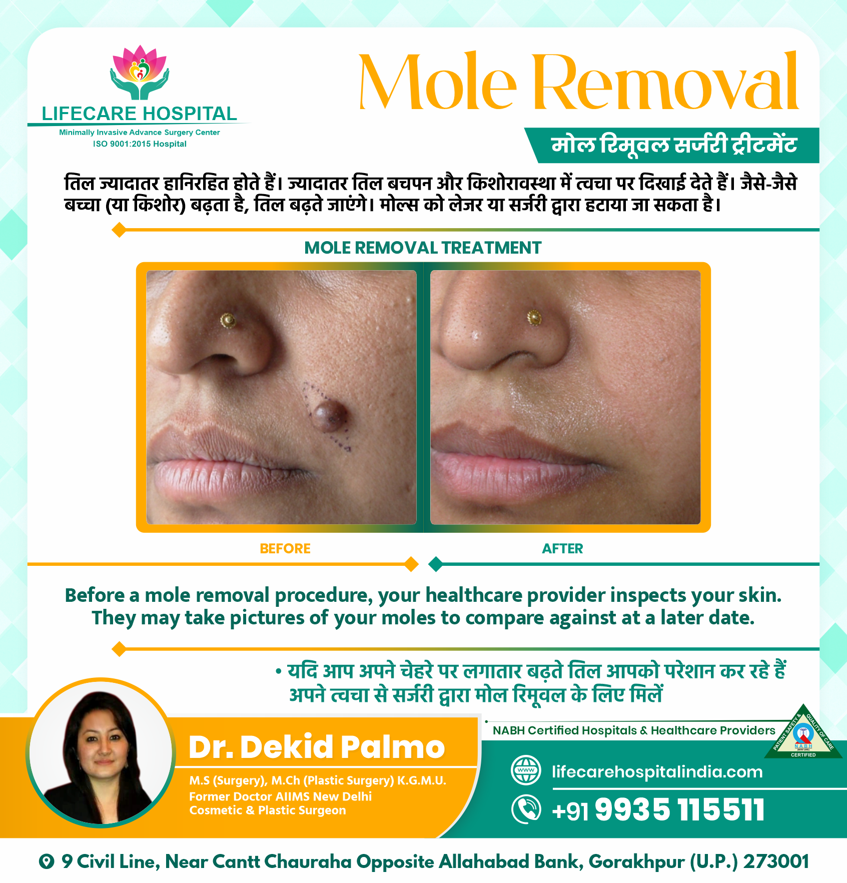 Mole Removal LIFECARE HOSPITAL Mole Removal LIFECARE HOSPITAL