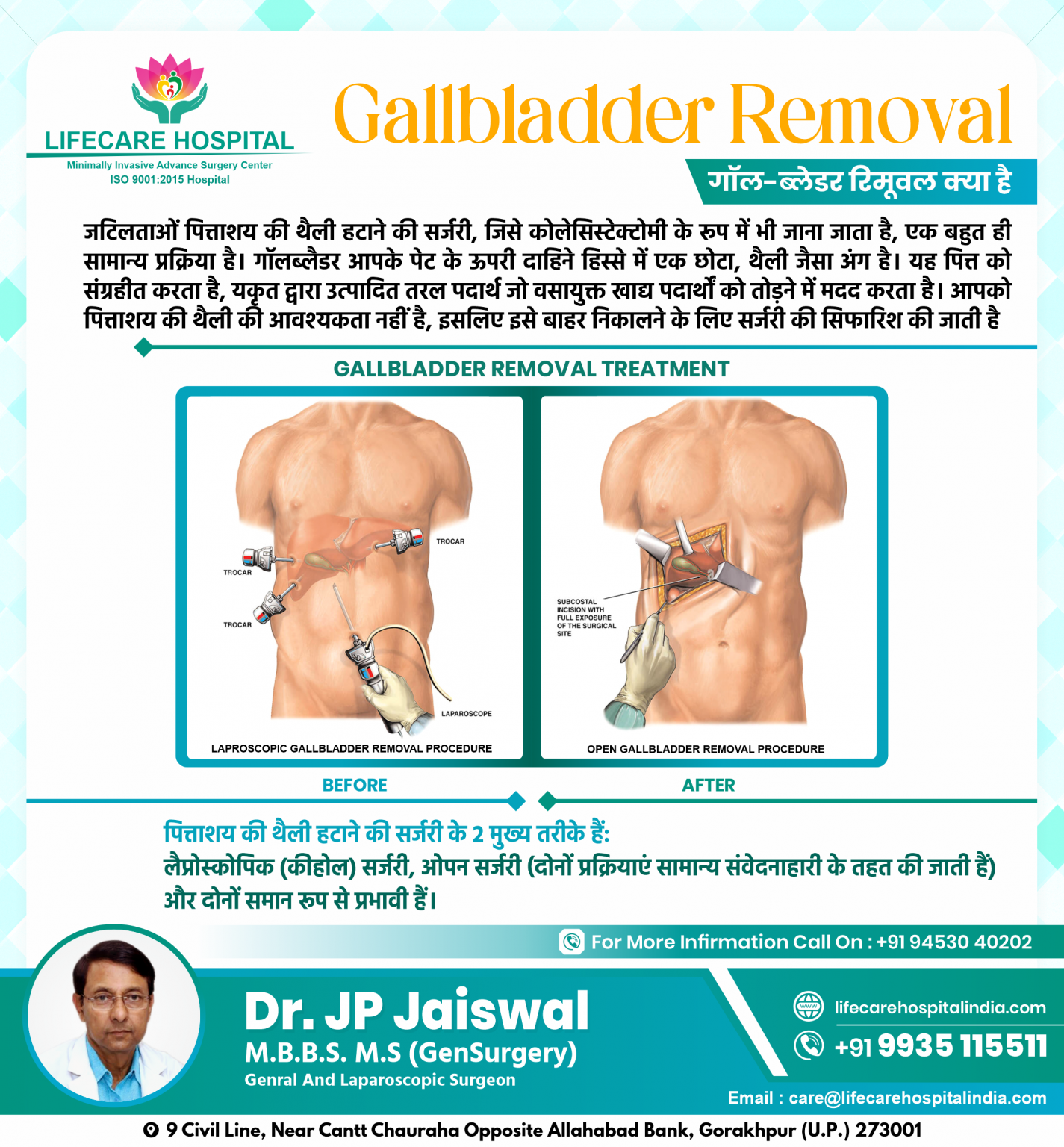 Gallbladder Removal LIFECARE HOSPITAL Gallbladder Removal LIFECARE HOSPITAL