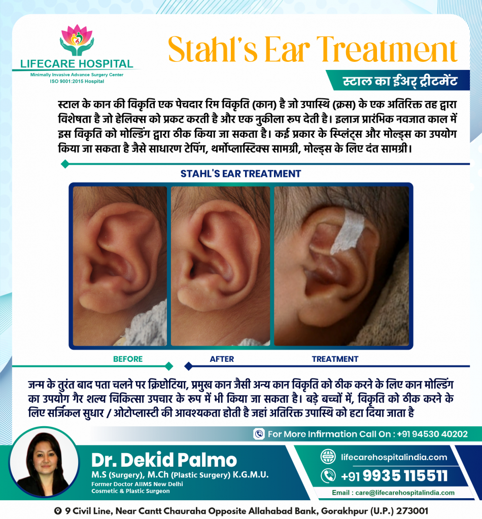 Stahl's Ear Treatment - LIFECARE HOSPITAL