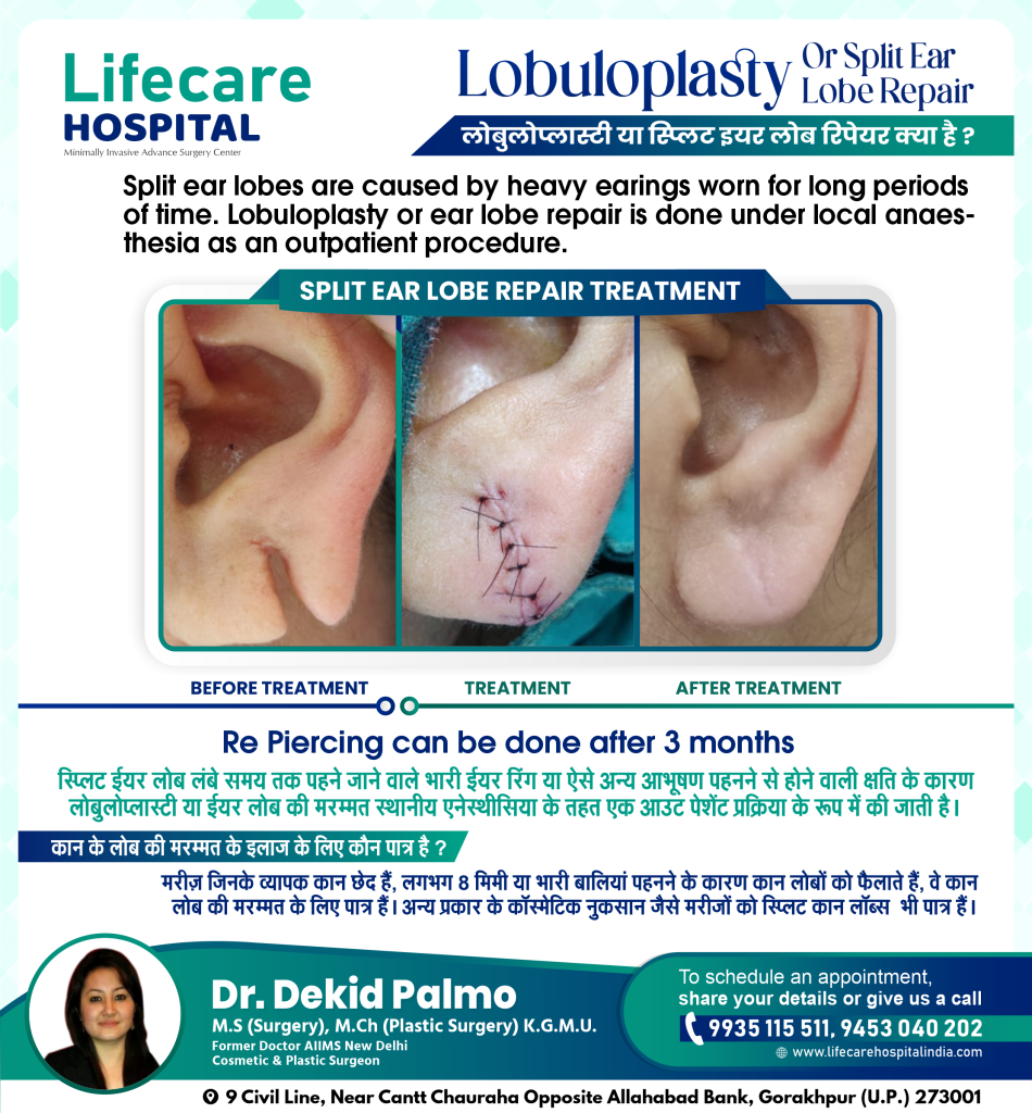 Lobuloplasty or Split Ear Lobe Repair - LIFECARE HOSPITAL