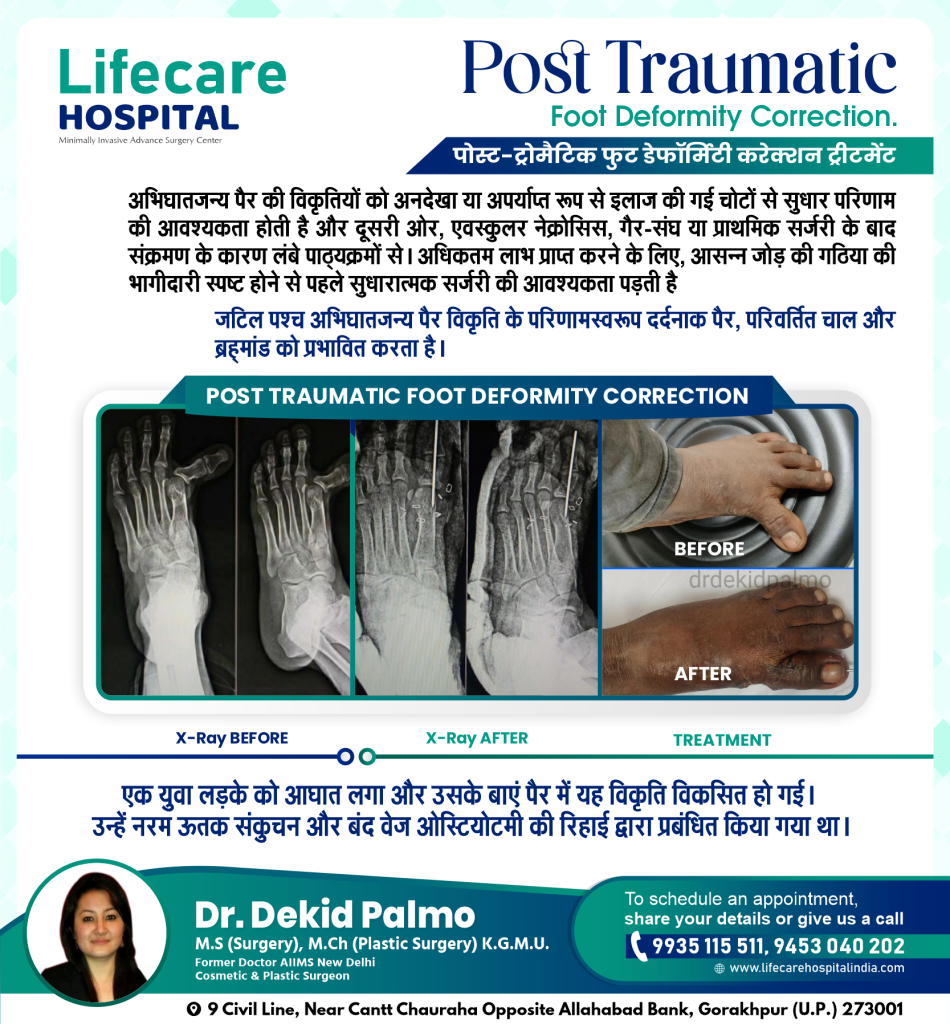 Post traumatic foot deformity correction. - LIFECARE HOSPITAL